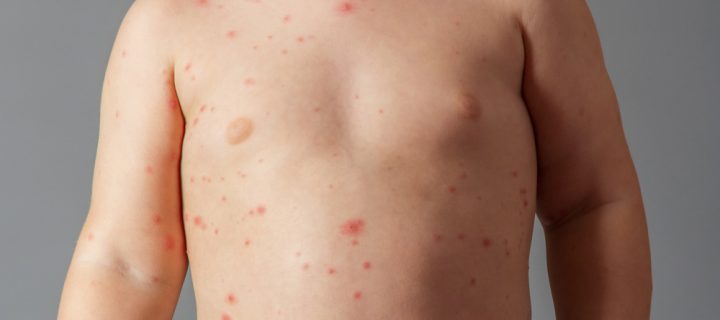 How to Avoid Swimmer’s Itch - RateMDs Health News